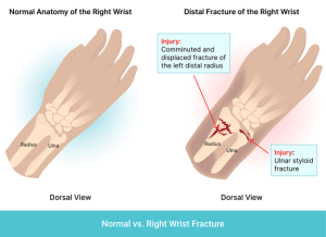 Understanding Bone Fracture In The Wrist